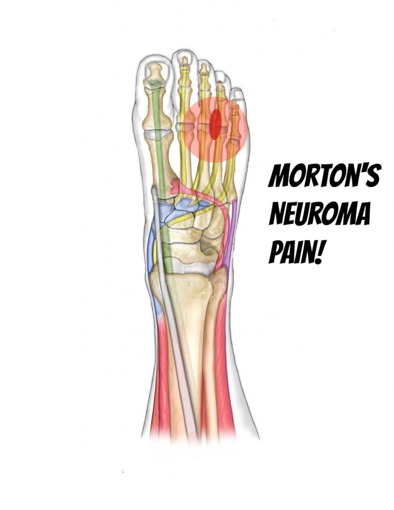 Morton's Neuroma: Causes and Pain Relief Solutions - J1 Insoles